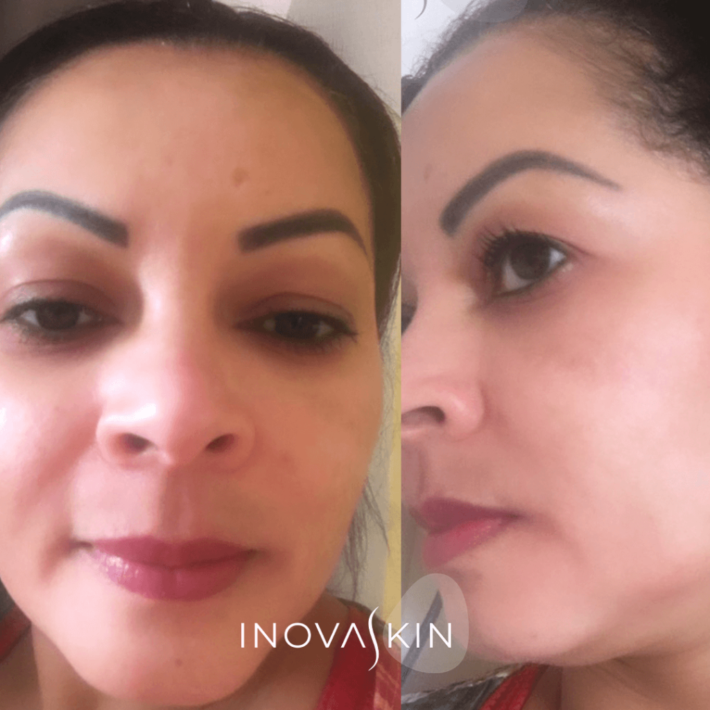 Tratamento - Inova Skin